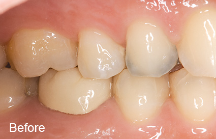 IPS e.max® | Quality Dental Restorations | Crown World Dental Lab